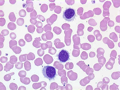 Image Challenge: 54-Year-Old Man With Abnormal Circulating Lymphocytes ...