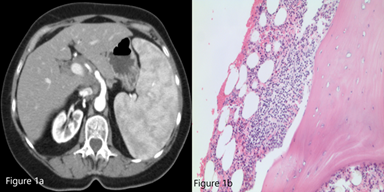 78-Year-Old Woman with Thrombocytopenia and Splenomegaly - Hematology.org