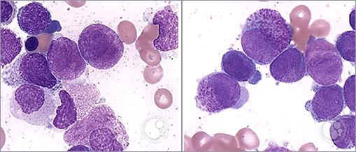 Case Study: 32-year old man with neurologic changes and cytopenias ...