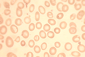 Hematology Glossary - Hematology.org
